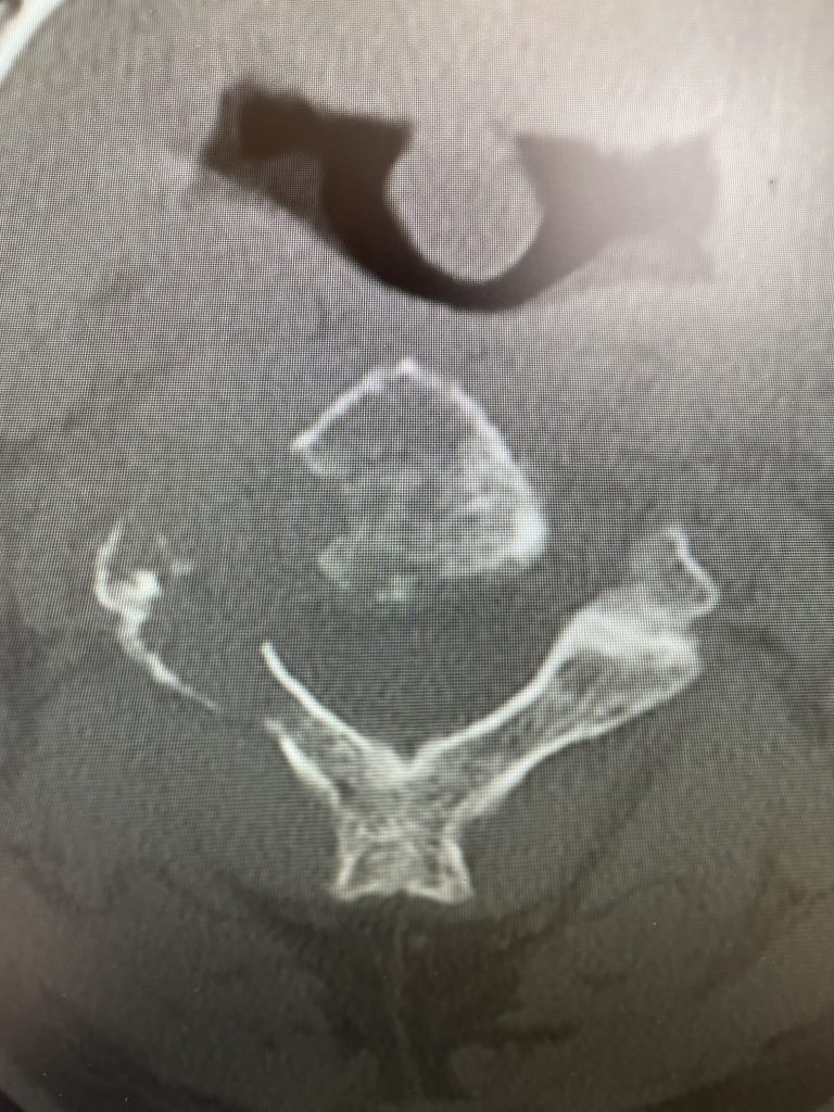 72-Year-Old Male With Progressive Neck Pain | NSPC Brain & Spine Surgery